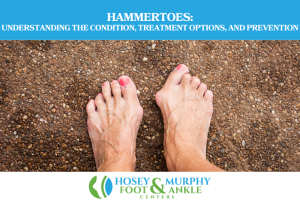 Hammertoes: Understanding the Condition, Treatment Options, and ...